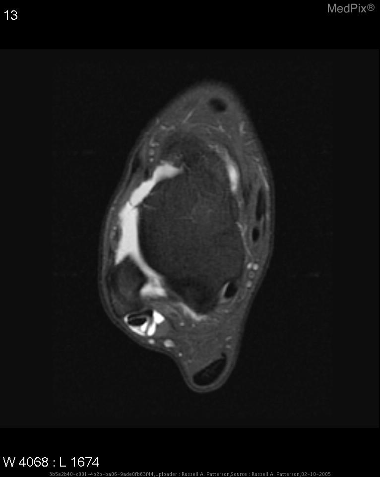 Anterior Talofibular Ligament Mri